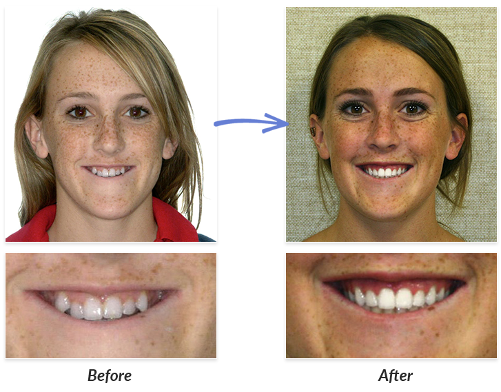 before-and-after-braces-photo-52 | DeLurgio Orthodontics : DeLurgio ...